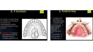 flap designs.pdf | Dental Health | Diseases and Conditions