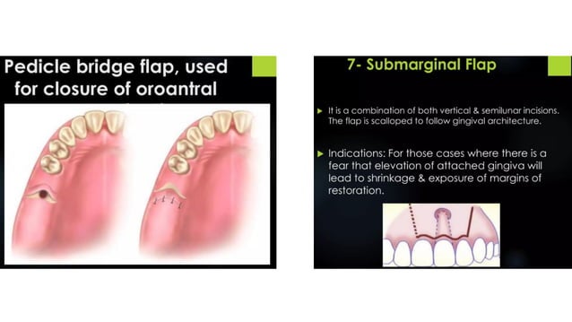 flap designs.pdf | Dental Health | Diseases and Conditions