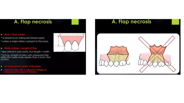 flap designs.pdf | Dental Health | Diseases and Conditions