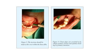flap designs.pdf | Dental Health | Diseases and Conditions