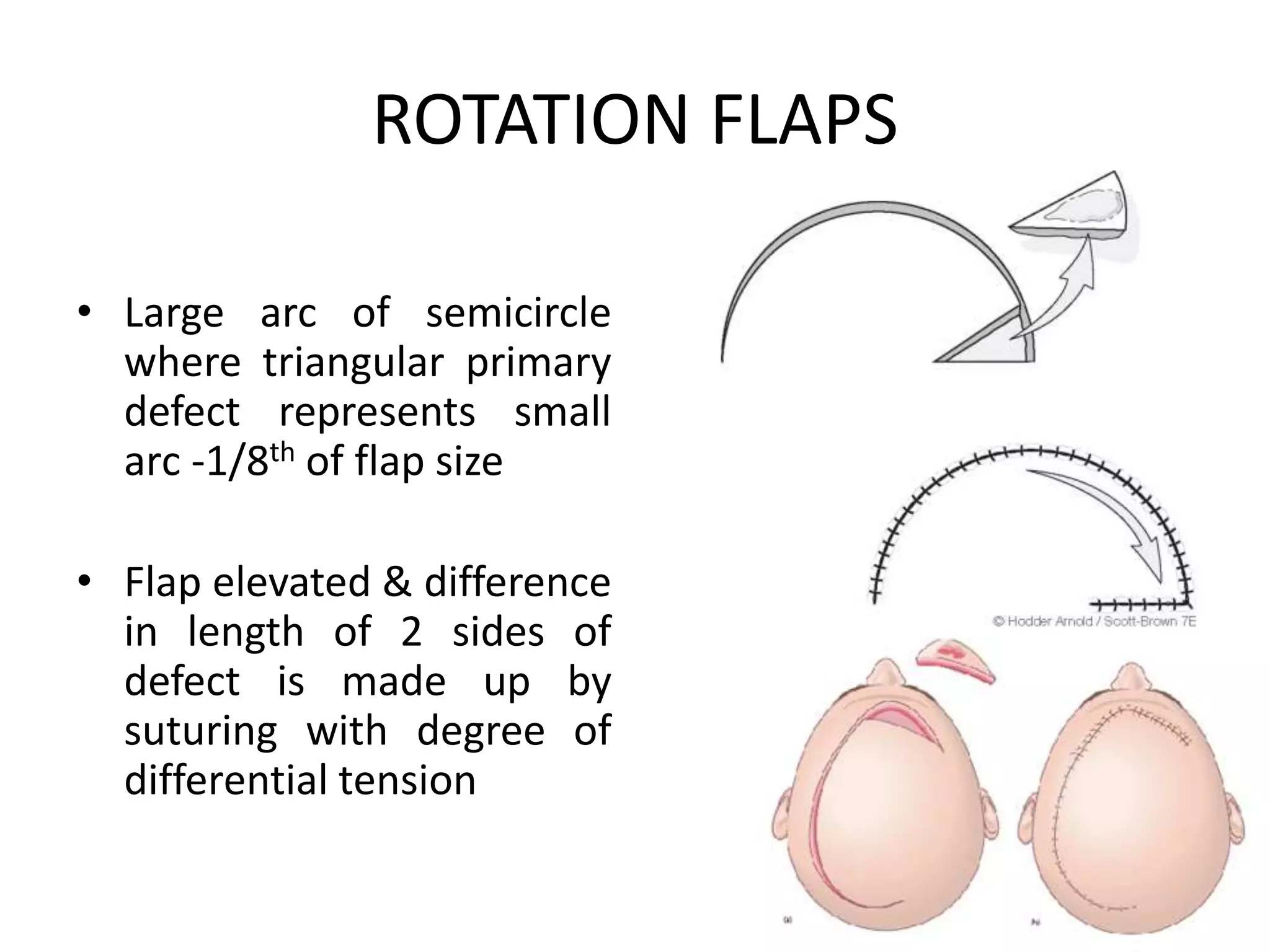 Flap in head and neck surgery part 1 | PPTX