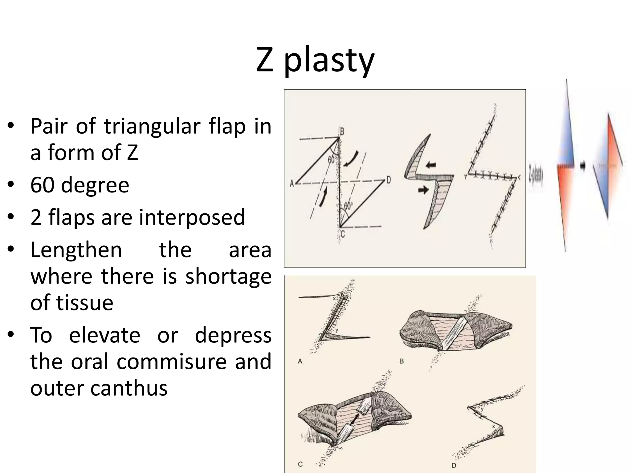 Flap in head and neck surgery part 1 | PPTX