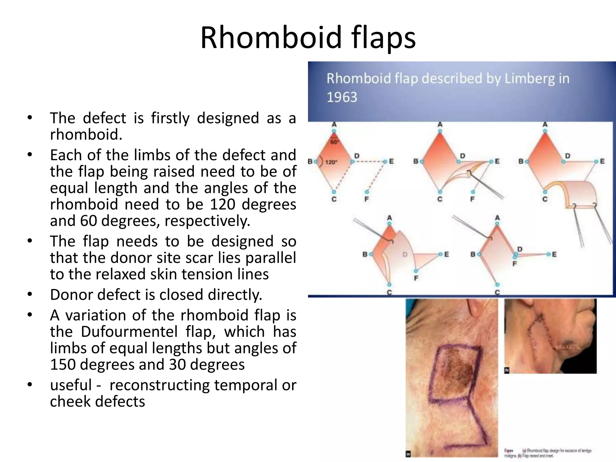 Flap in head and neck surgery part 1 | PPTX