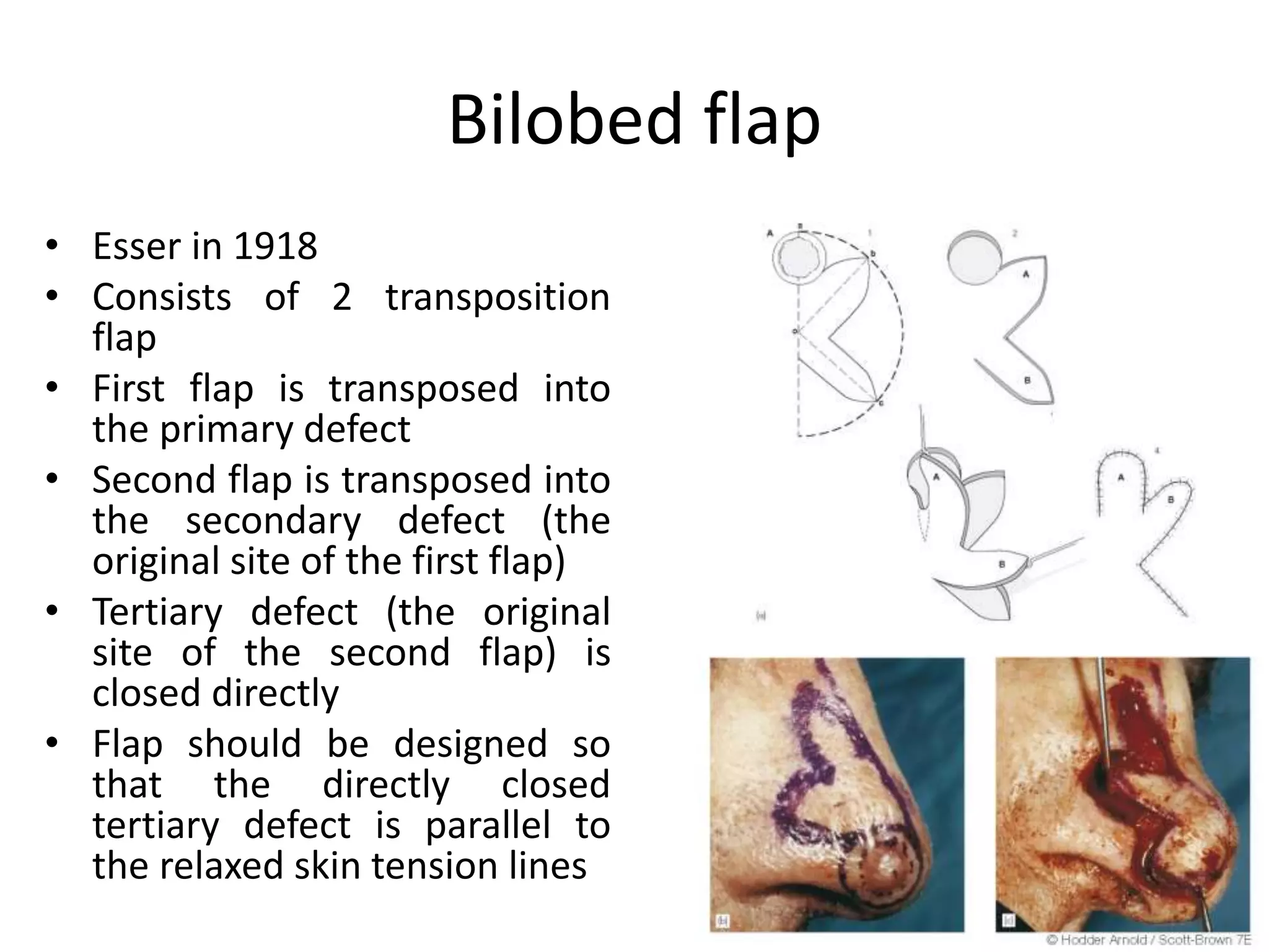 Flap in head and neck surgery part 1 | PPTX