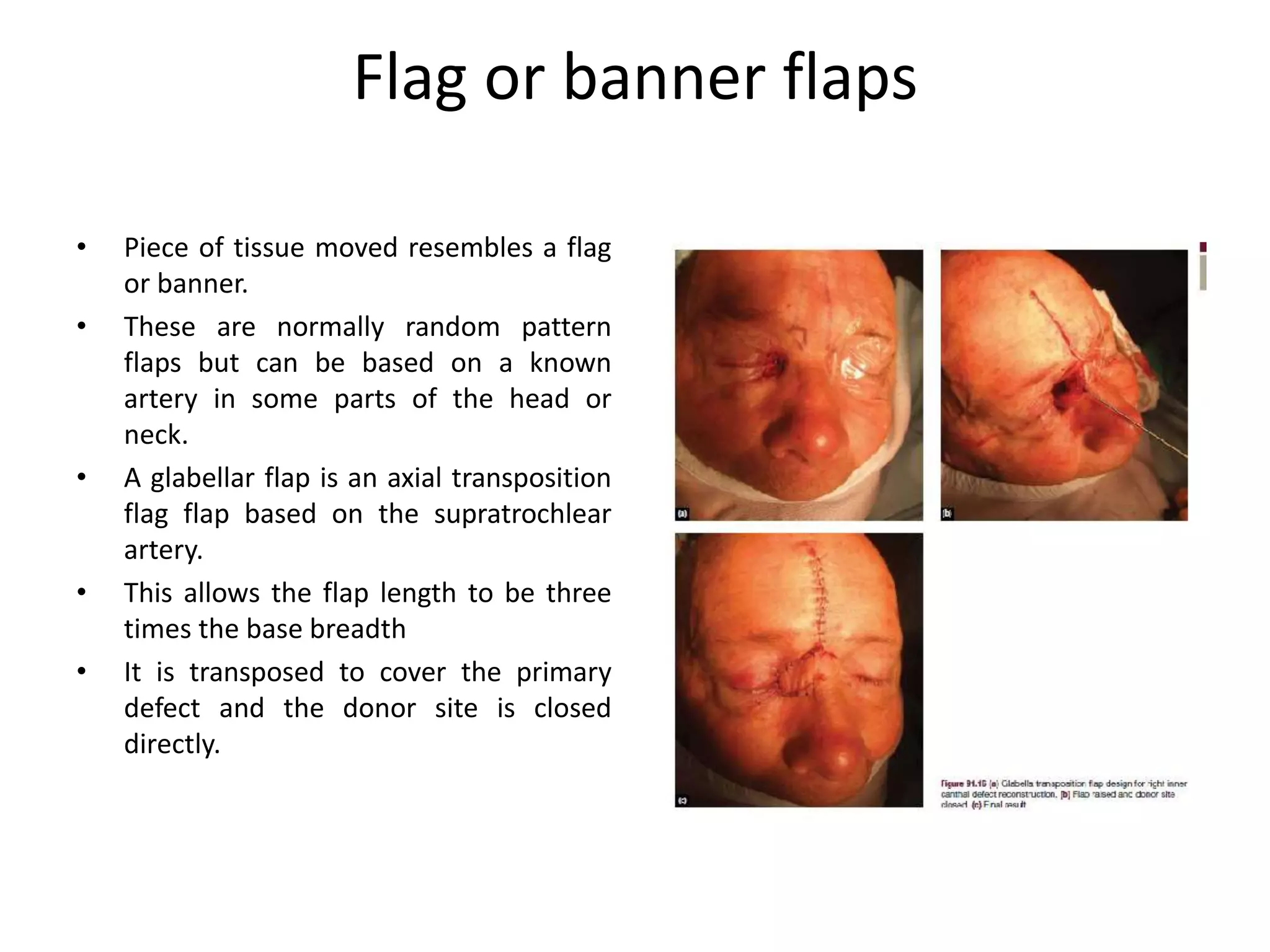 Flap in head and neck surgery part 1 | PPTX