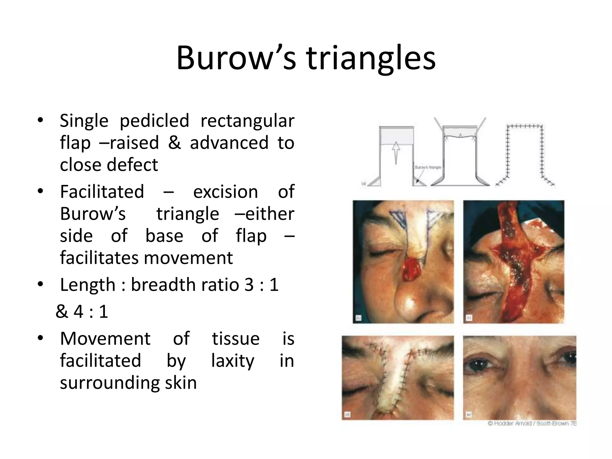 Flap in head and neck surgery part 1 | PPTX