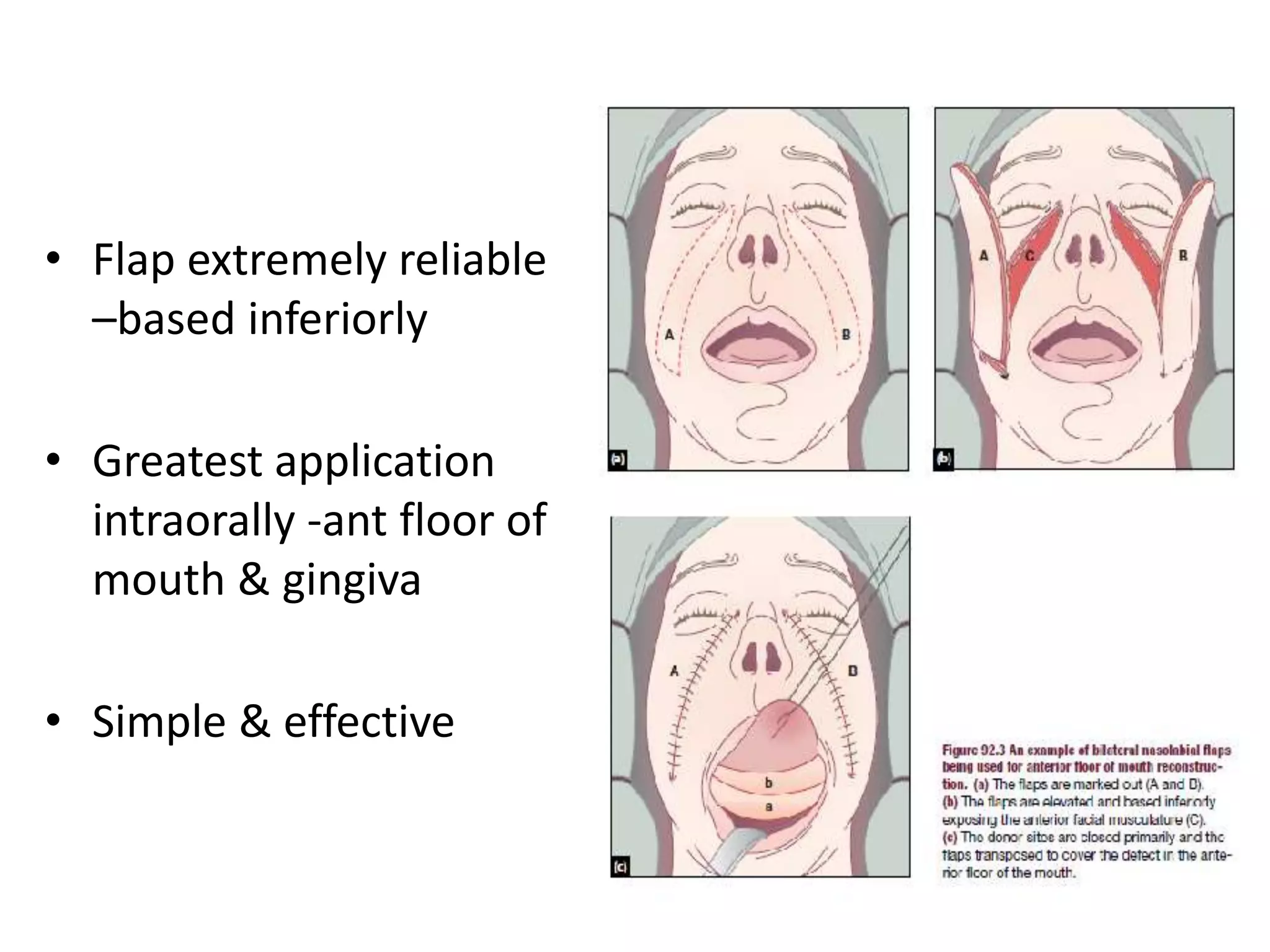Flap in head and neck surgery part 1 | PPTX