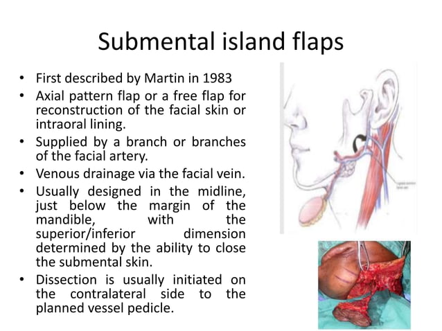 Flap in head and neck surgery part 1 | PPTX