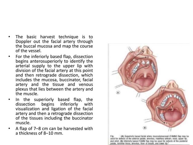 Flap in head and neck surgery part 1 | PPTX