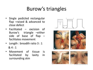 Flap in head and neck surgery part 1 | PPT
