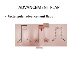 Flap in surgery | PPTX