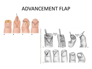 Flap in surgery | PPTX