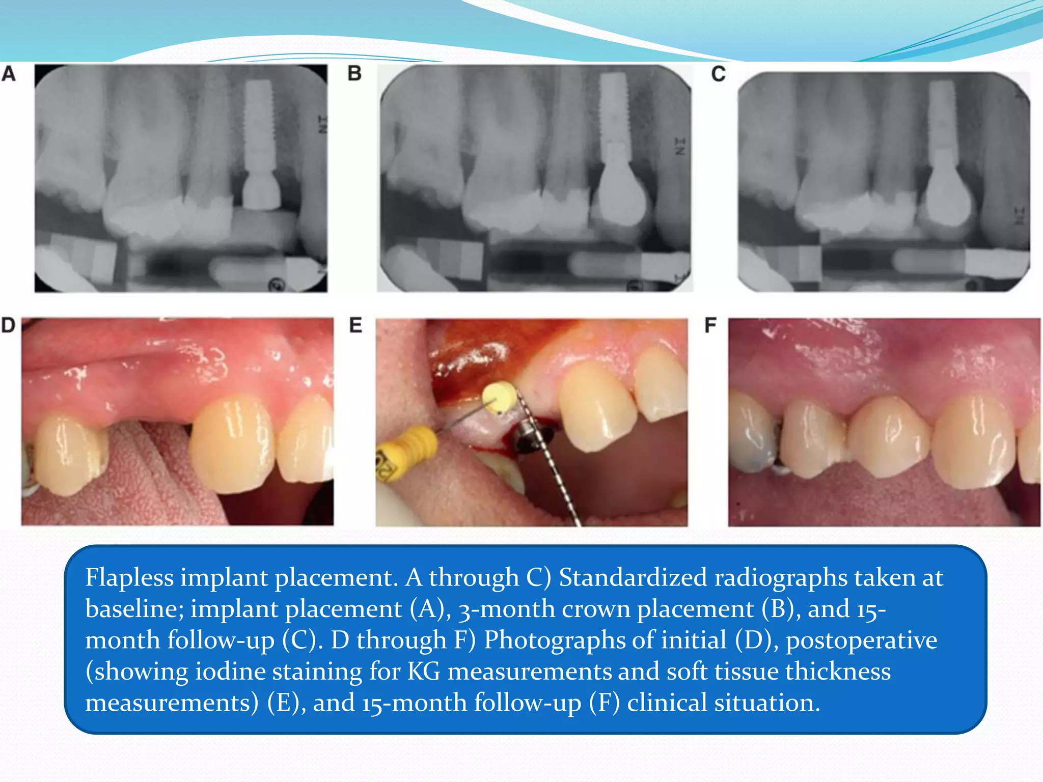 Flapless implant surgery | PPTX