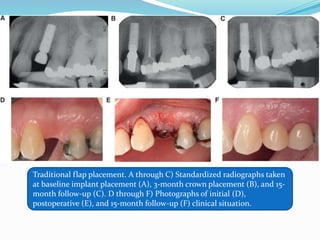 Flapless implant surgery | PPTX