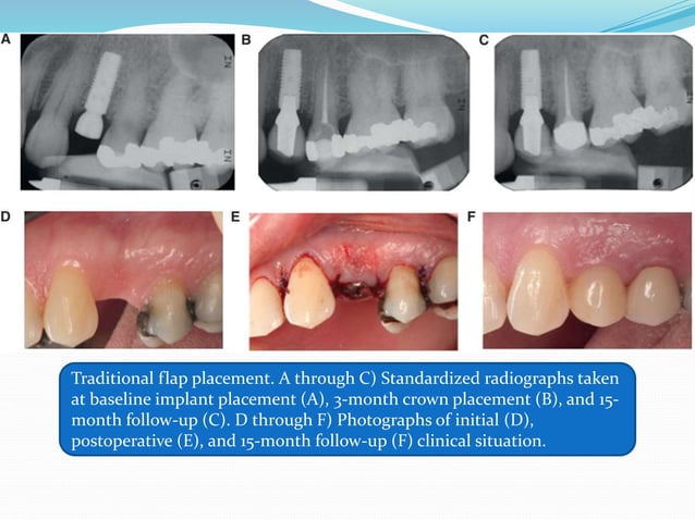 Flapless implant surgery | PPTX