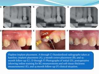 Flapless implant surgery | PPTX