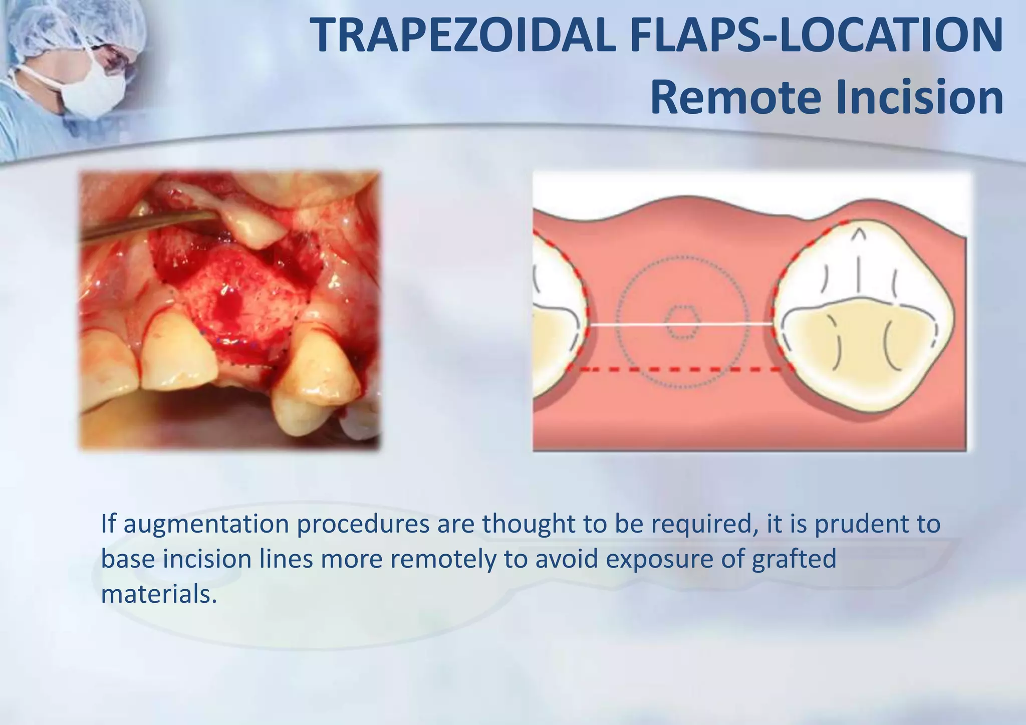 Flap management improved | PPTX
