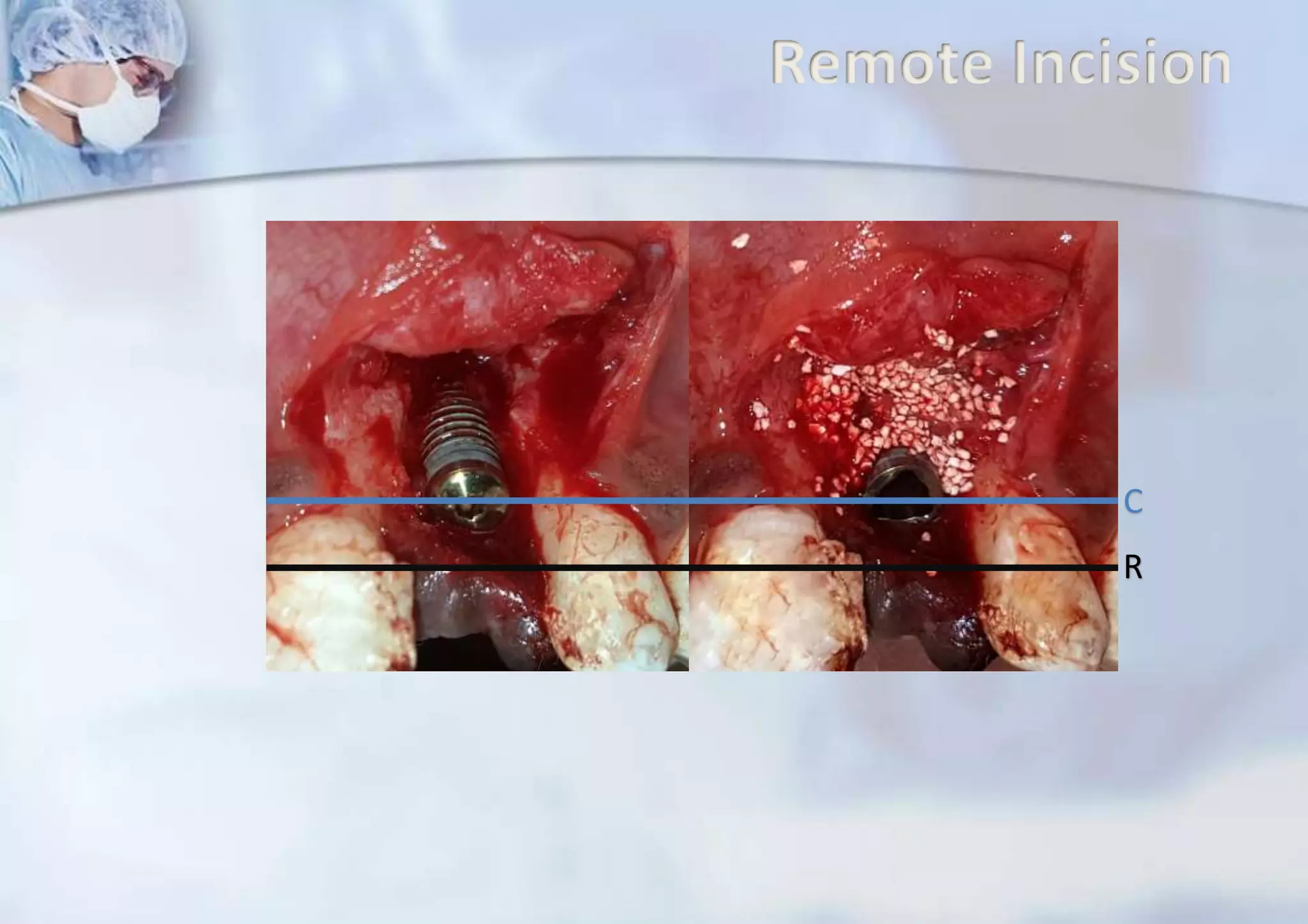 Flap management improved | PPTX
