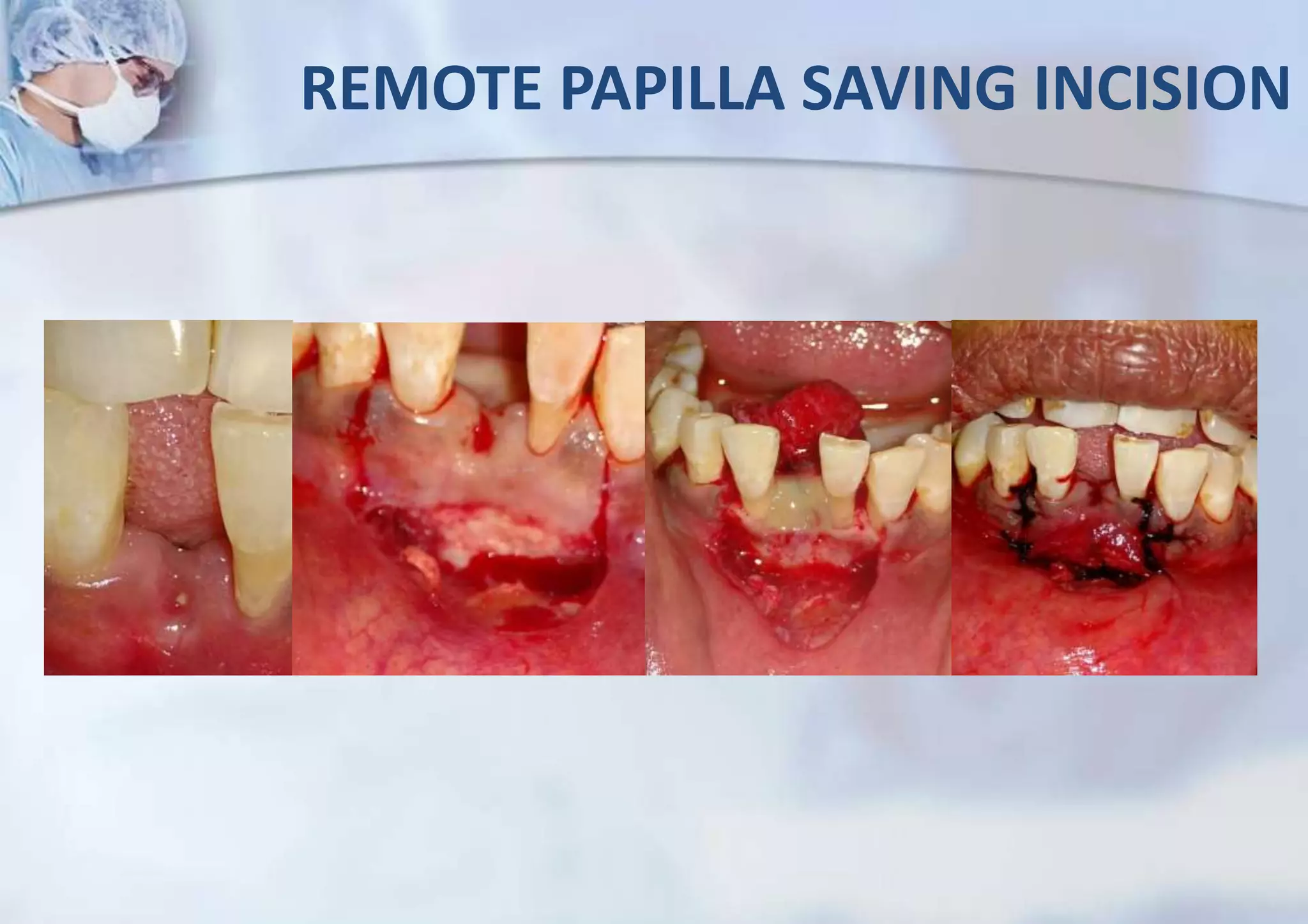 Flap management improved | PPTX