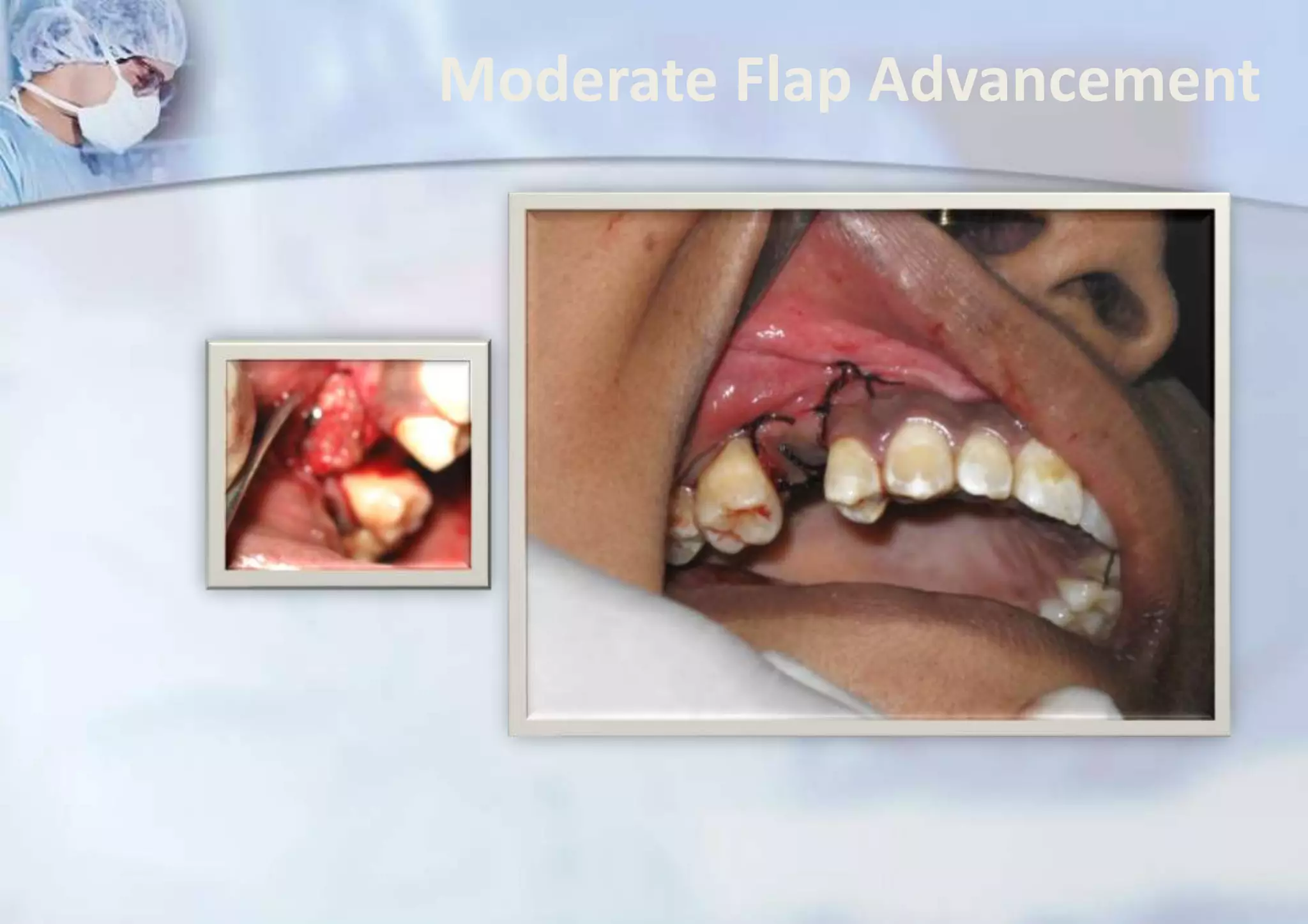 Flap management improved | PPTX