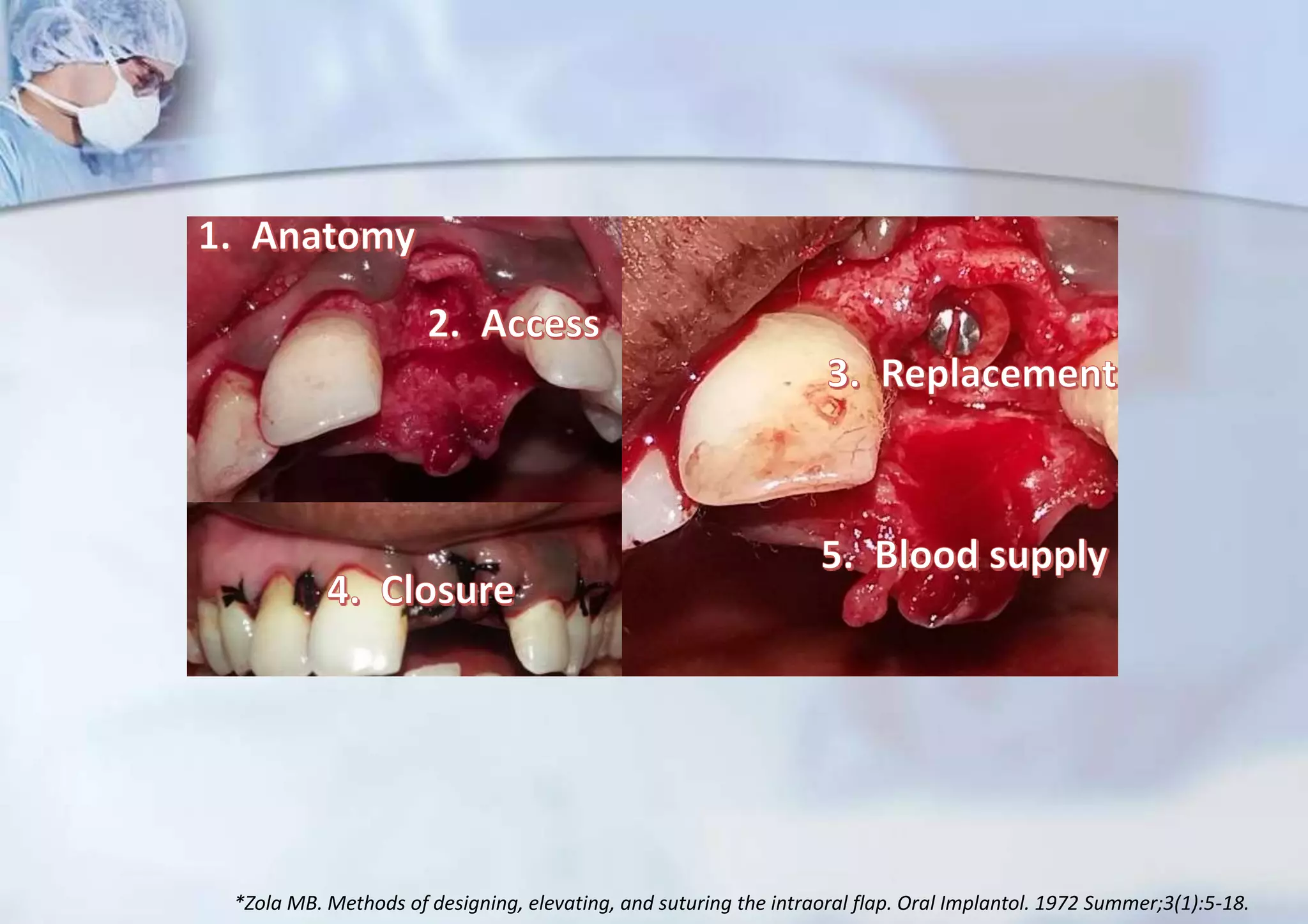 Flap management improved | PPTX