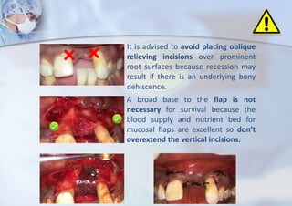 Flap management improved | PPTX