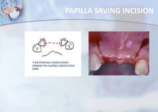 Flap management improved | PPTX