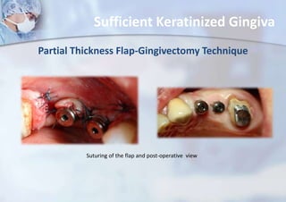 Flap management improved | PPTX