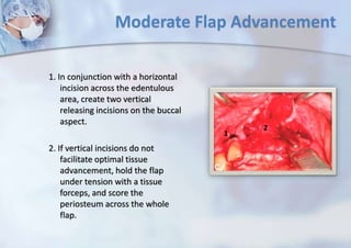 Flap management improved | PPTX