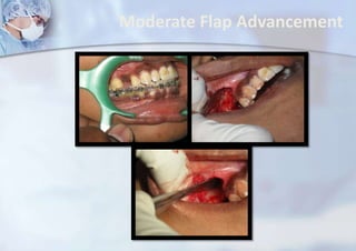 Flap management improved | PPTX