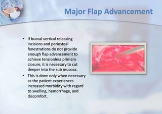 Flap management improved | PPTX