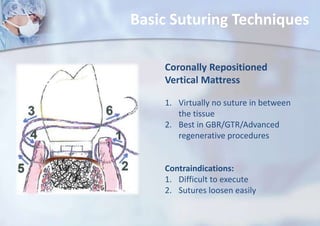 Flap management improved | PPTX