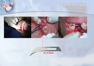 Flap management improved | PPTX