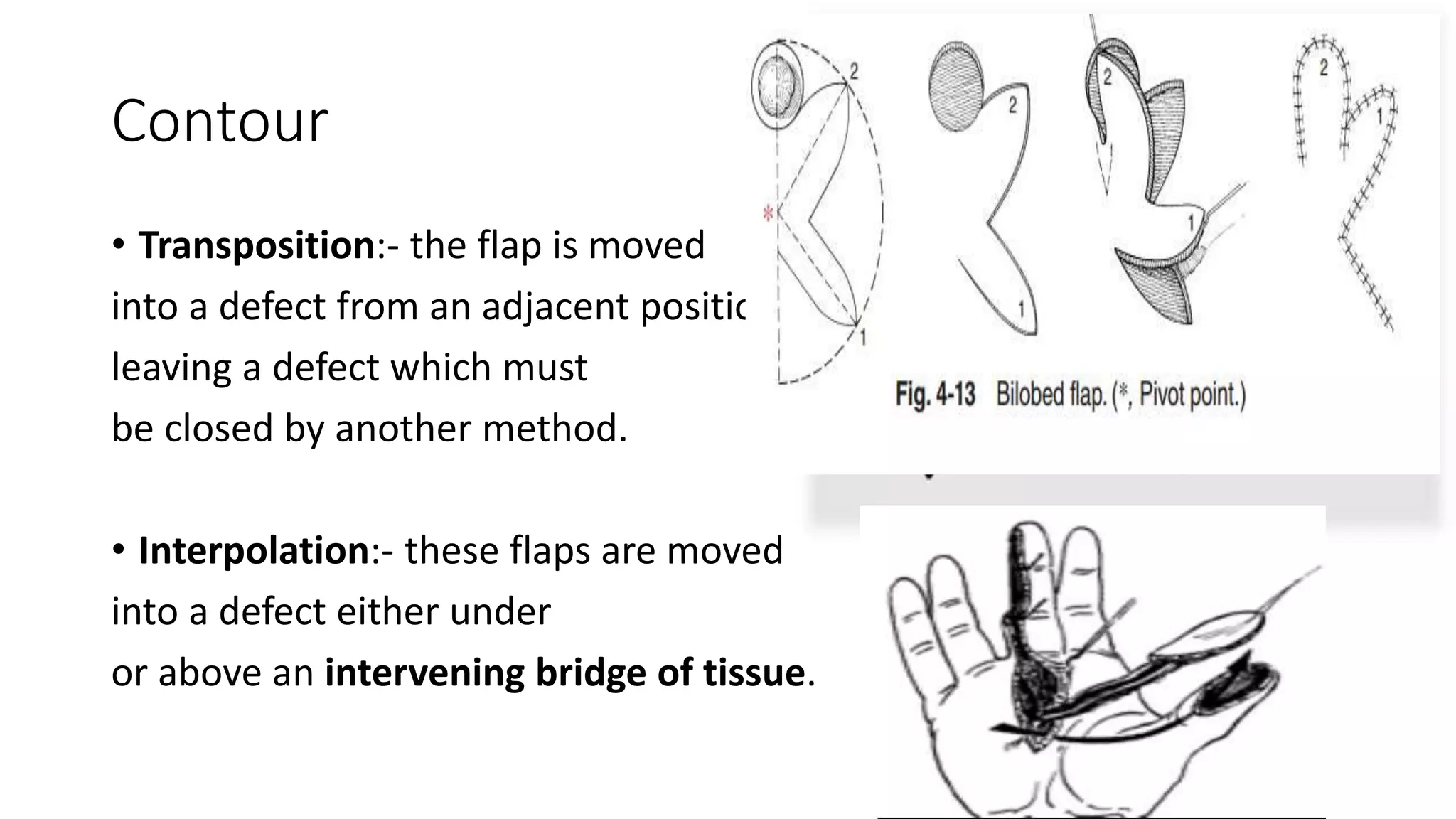 Flaps and grafts in plastic surgery | PPTX