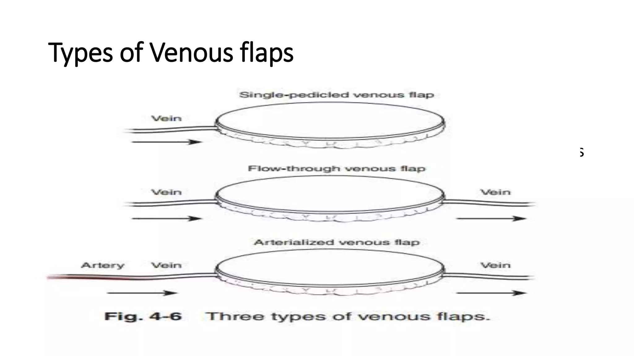 Flaps and grafts in plastic surgery | PPTX