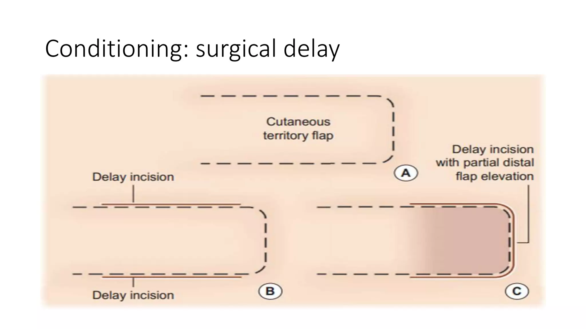 Flaps and grafts in plastic surgery | PPTX