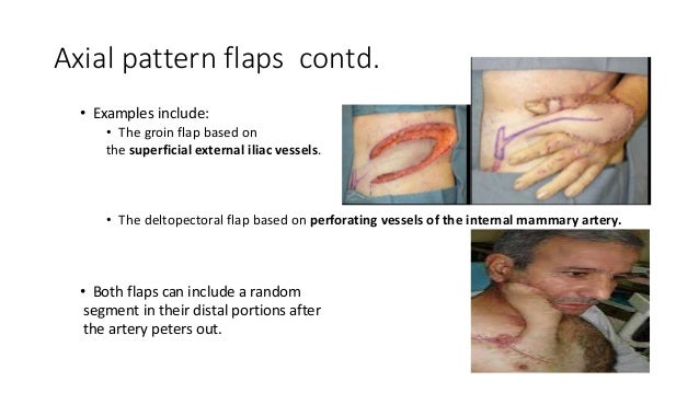 Flaps and grafts in plastic surgery