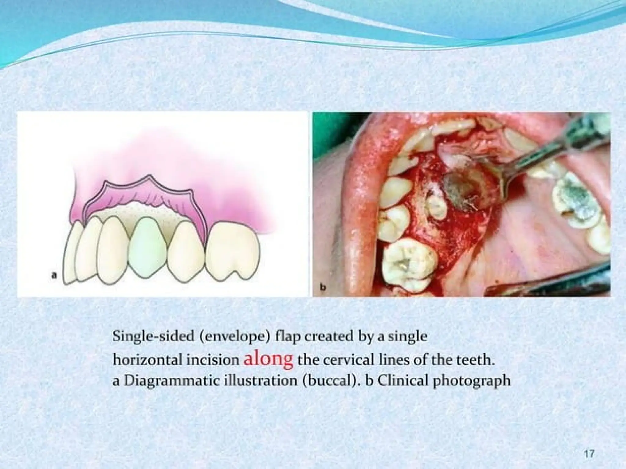Incisions and intra oral flap design | PPTX