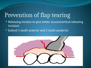 Incisions and intra oral flap design | PPTX