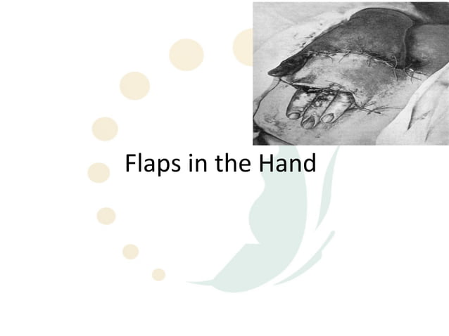Flaps in-the-hand | PPT | Death, Injury, or Military Conflict ...