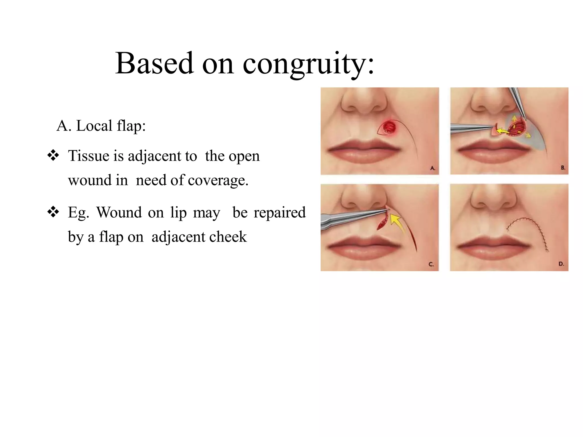 Flaps and its classification | PPTX