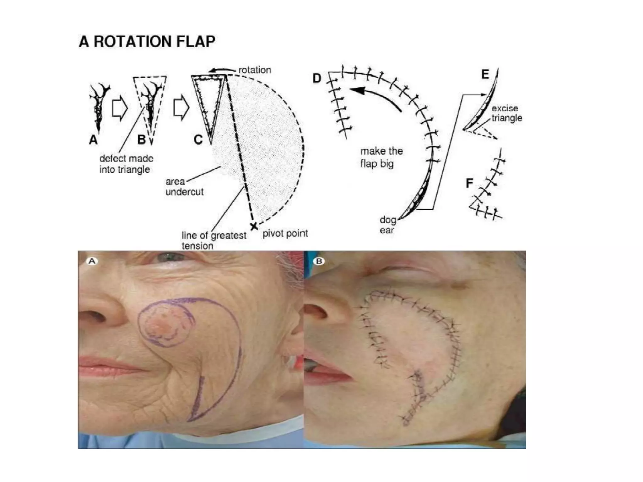 Flaps and its classification | PPTX