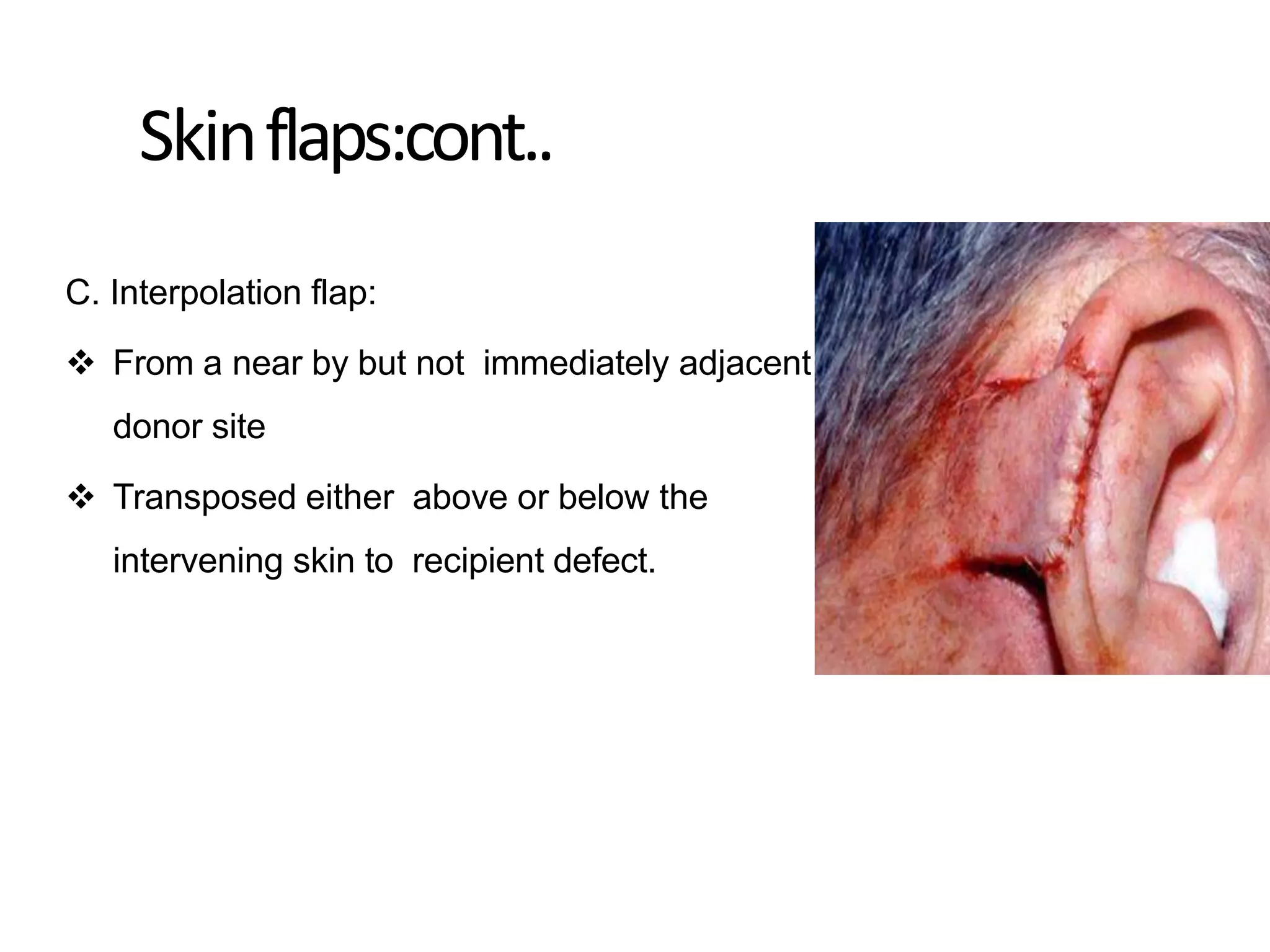 Flaps and its classification | PPTX