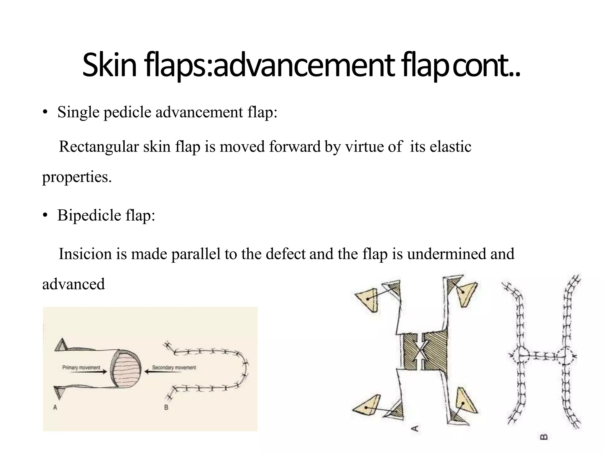 Flaps and its classification | PPTX