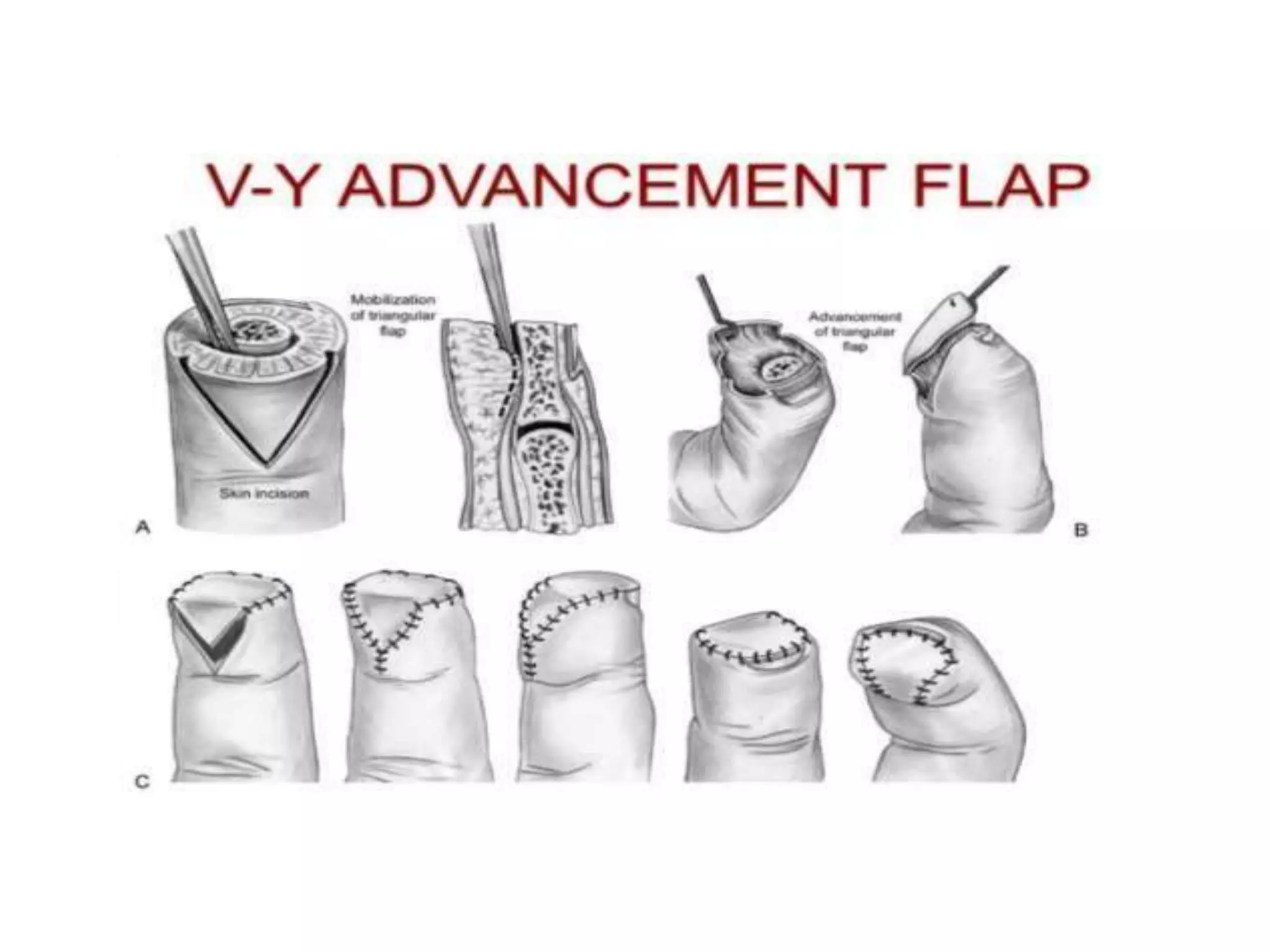 Flaps and its classification | PPTX