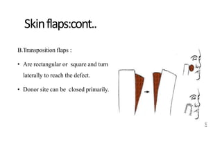 Flaps and its classification | PPTX