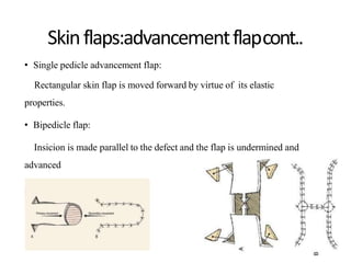 Flaps and its classification | PPTX