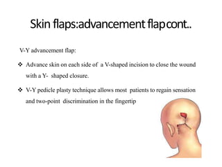 Flaps and its classification | PPTX