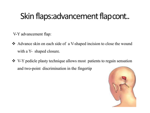 Flaps and its classification | PPTX
