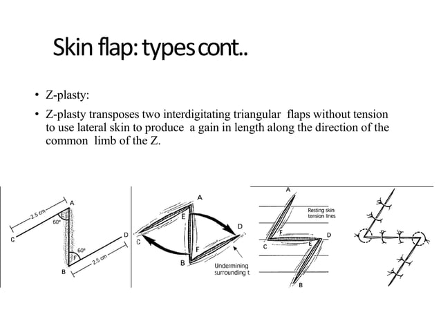 Flaps and its classification | PPTX